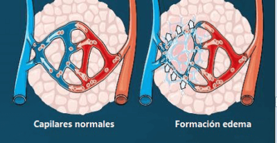 Diferencia entre Edema y Linfedema | Cincos